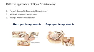 Benign Prostatic Hyperplasia | PPTX