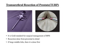 Benign Prostatic Hyperplasia | PPT