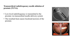 Benign Prostatic Hyperplasia | PPTX