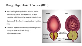 Benign Prostatic Hyperplasia | PPT