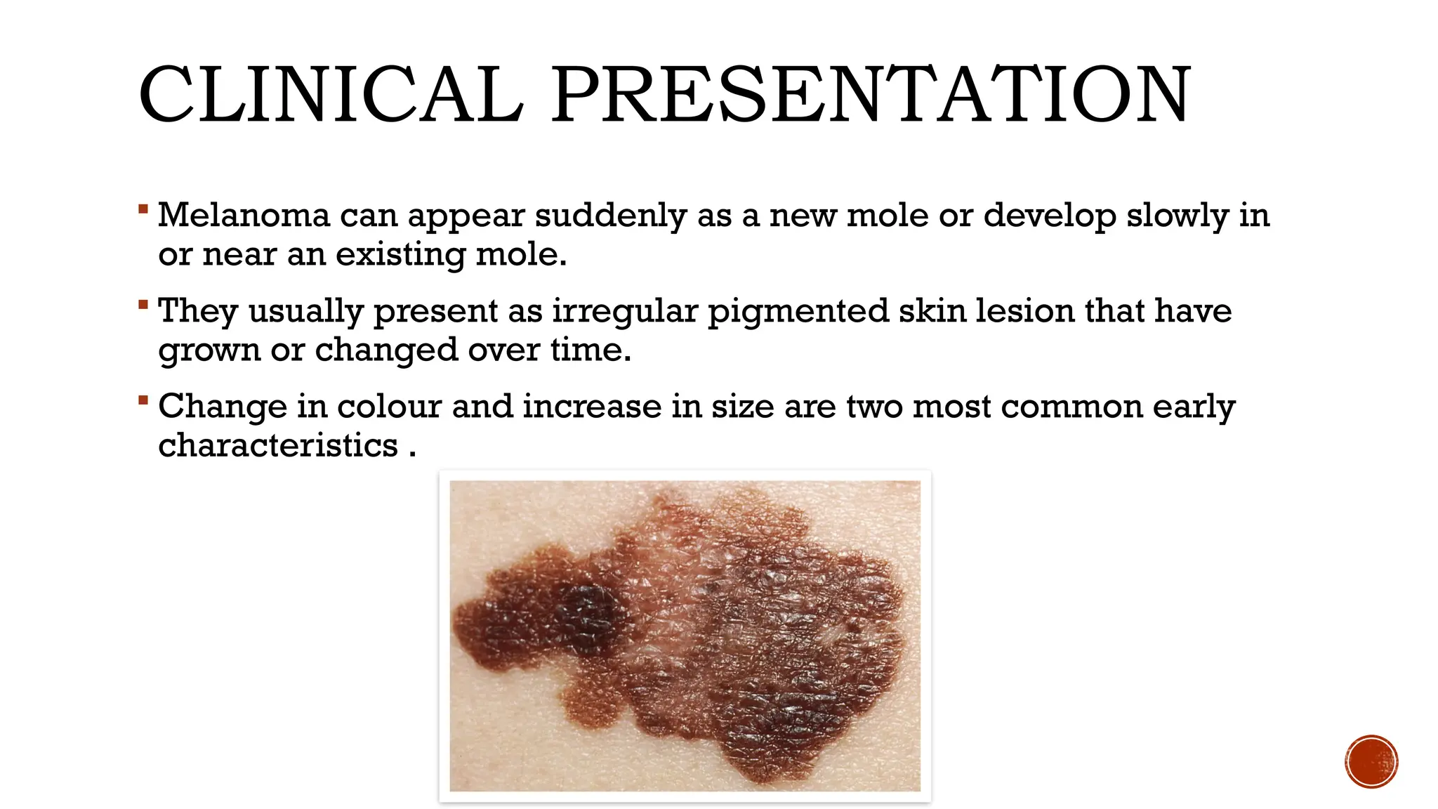 Melanoma a discourse by surgical resident .pptx