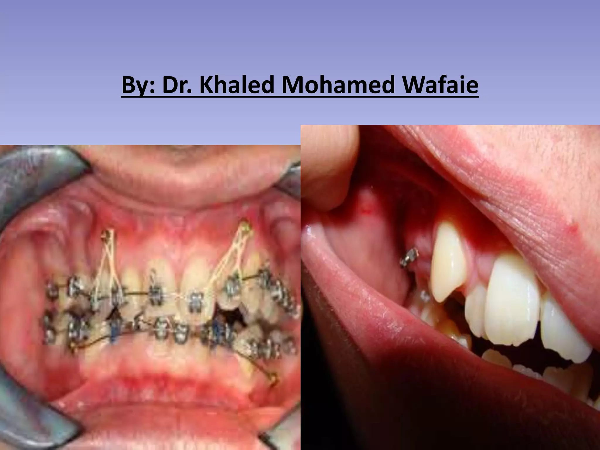 Temporary Anchorage Device (TAD) or Mini (screw ,implant) | PPTX