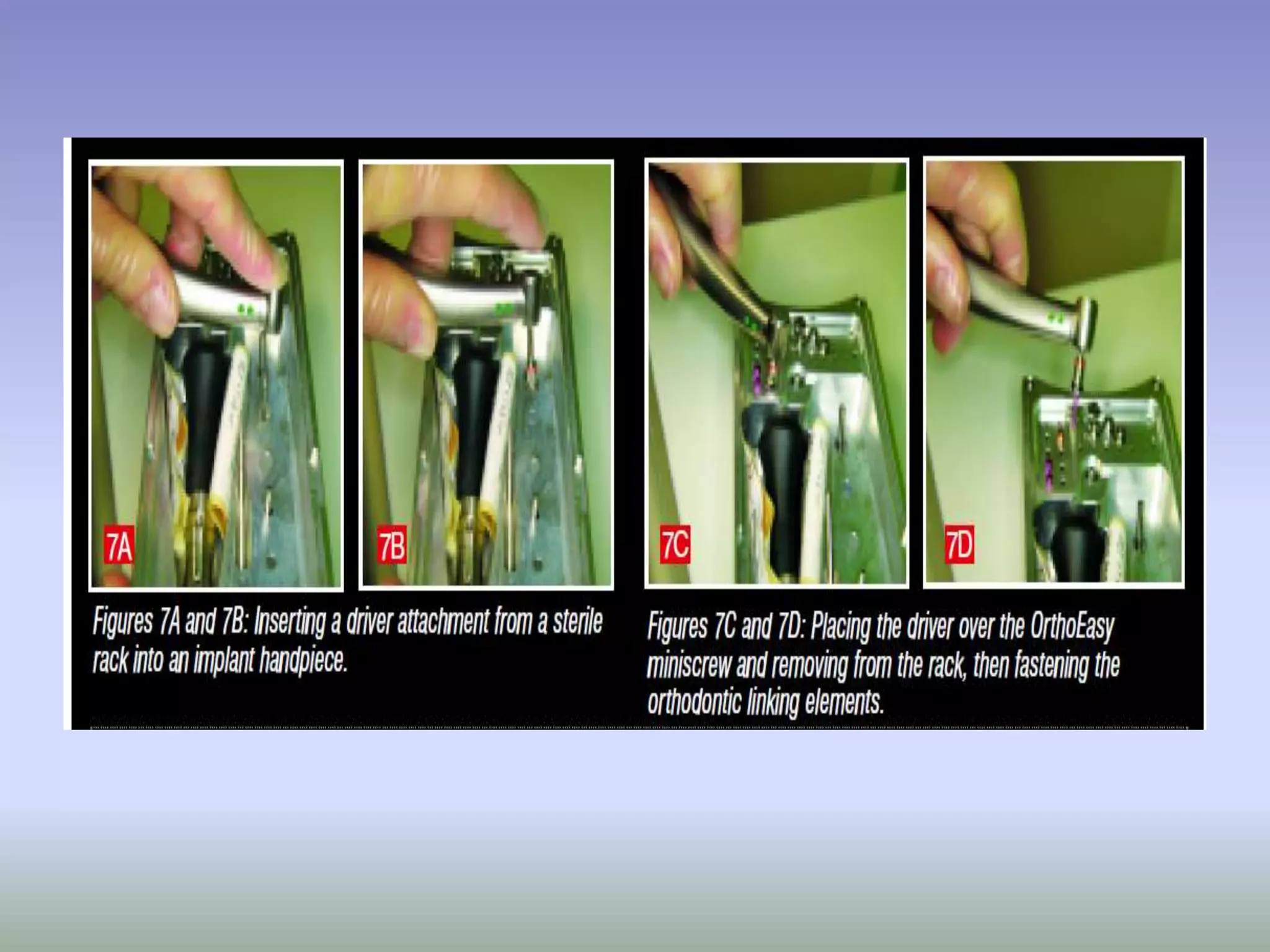 Temporary Anchorage Device (TAD) or Mini (screw ,implant) | PPTX