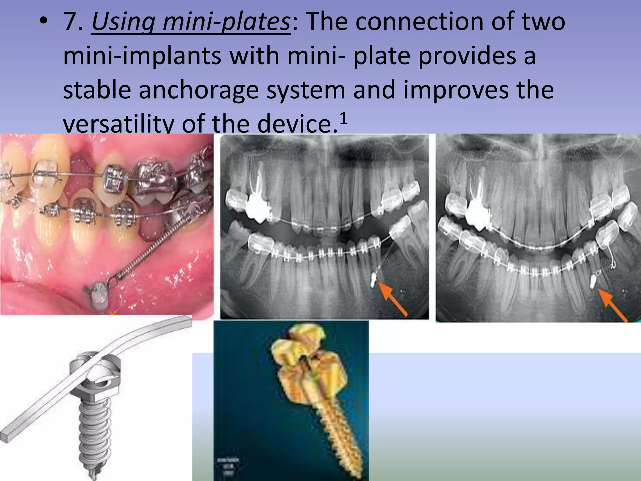 Temporary Anchorage Device (TAD) or Mini (screw ,implant) | PPTX