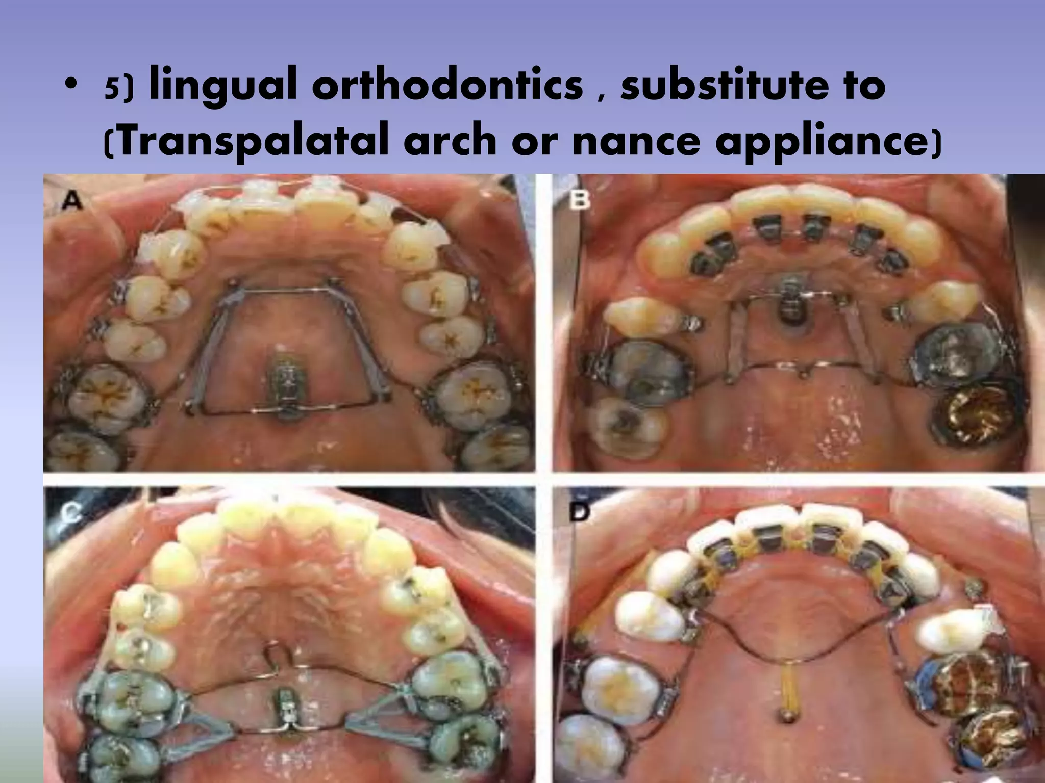 Temporary Anchorage Device (TAD) or Mini (screw ,implant) | PPTX