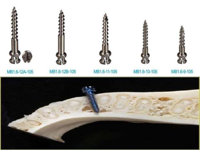 Temporary Anchorage Device (TAD) or Mini (screw ,implant)