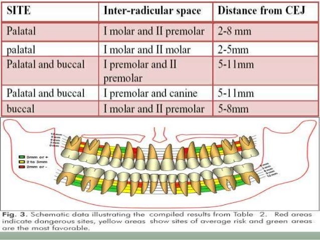 Temporary Anchorage Device (TAD) or Mini (screw ,implant)