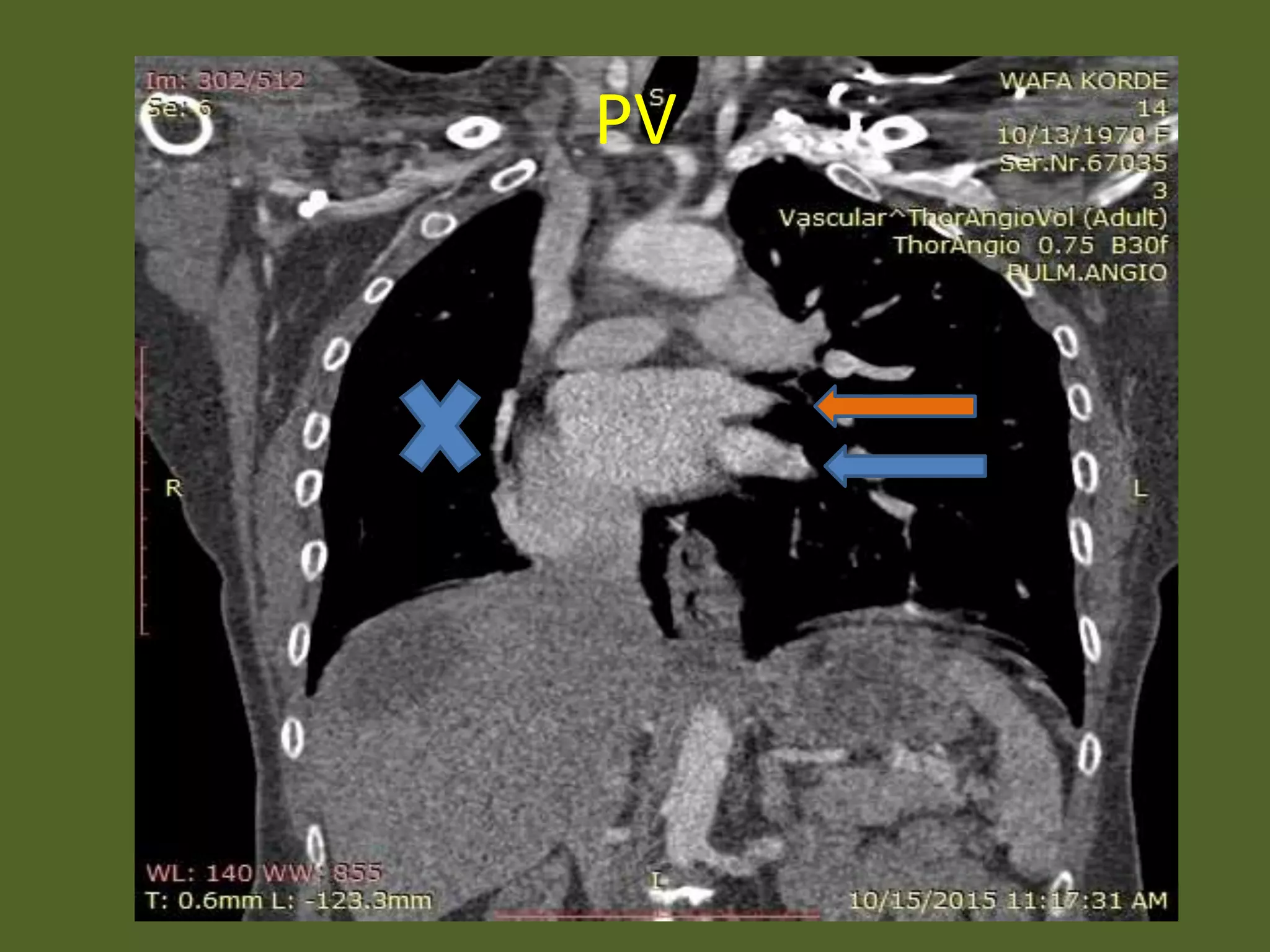 scimitar syndrome | PPTX