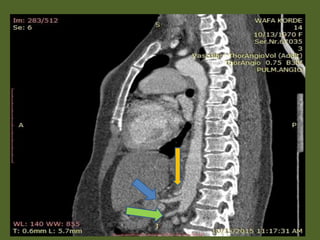 scimitar syndrome | PPTX