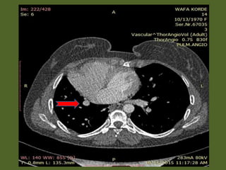 scimitar syndrome | PPTX