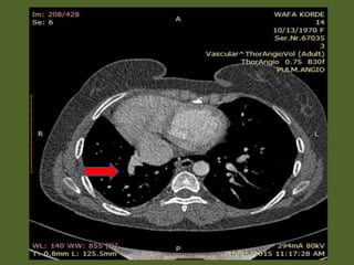 scimitar syndrome | PPTX