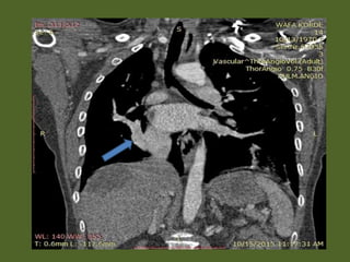 scimitar syndrome | PPTX
