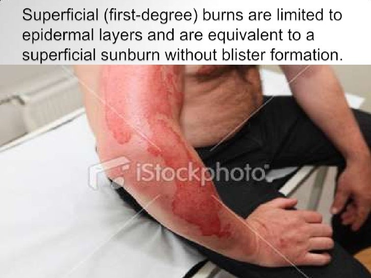 burn seminar