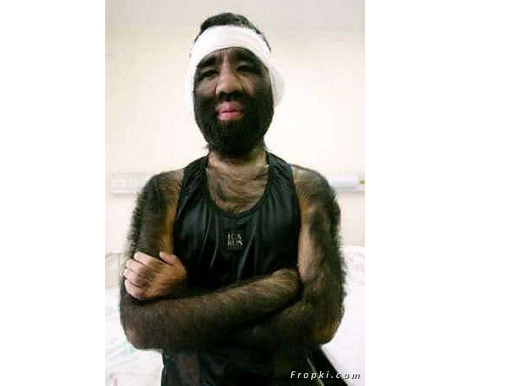 Real Human Deformities