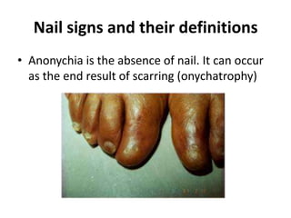 dermatology.nail disorder.(dr.mhamad usif) | PPTX