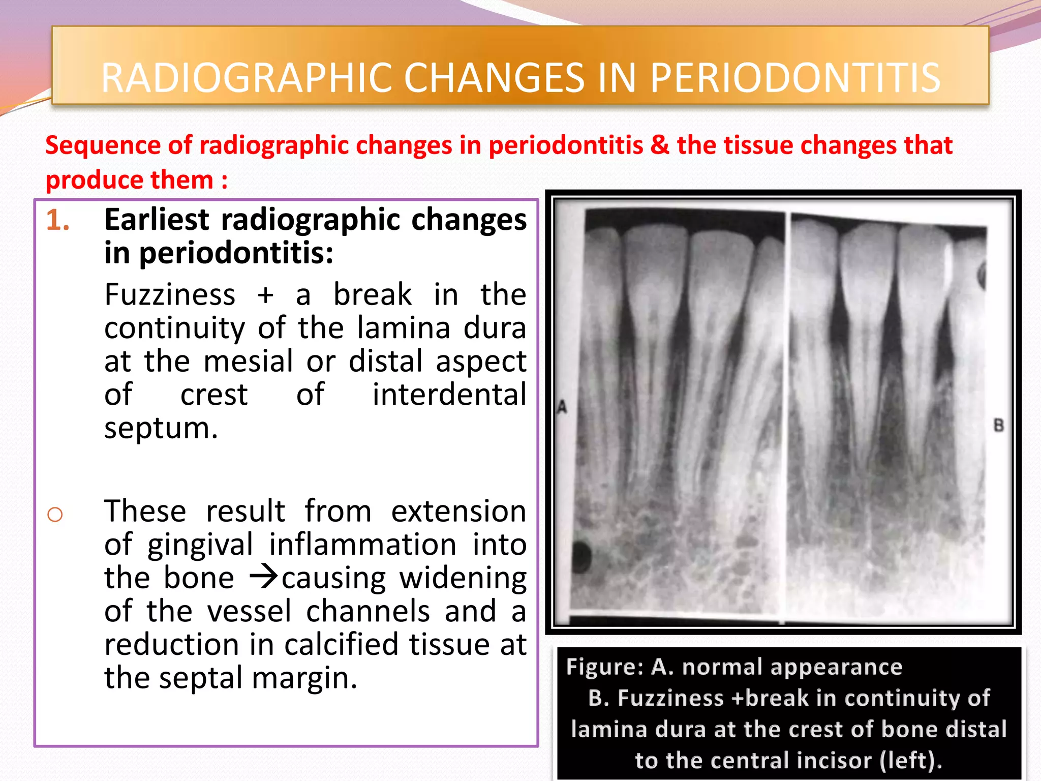 RADIOGRAPHIC AIDS IN THE DIAGNOSIS OF PERIODONTAL DISEASE | PPTX