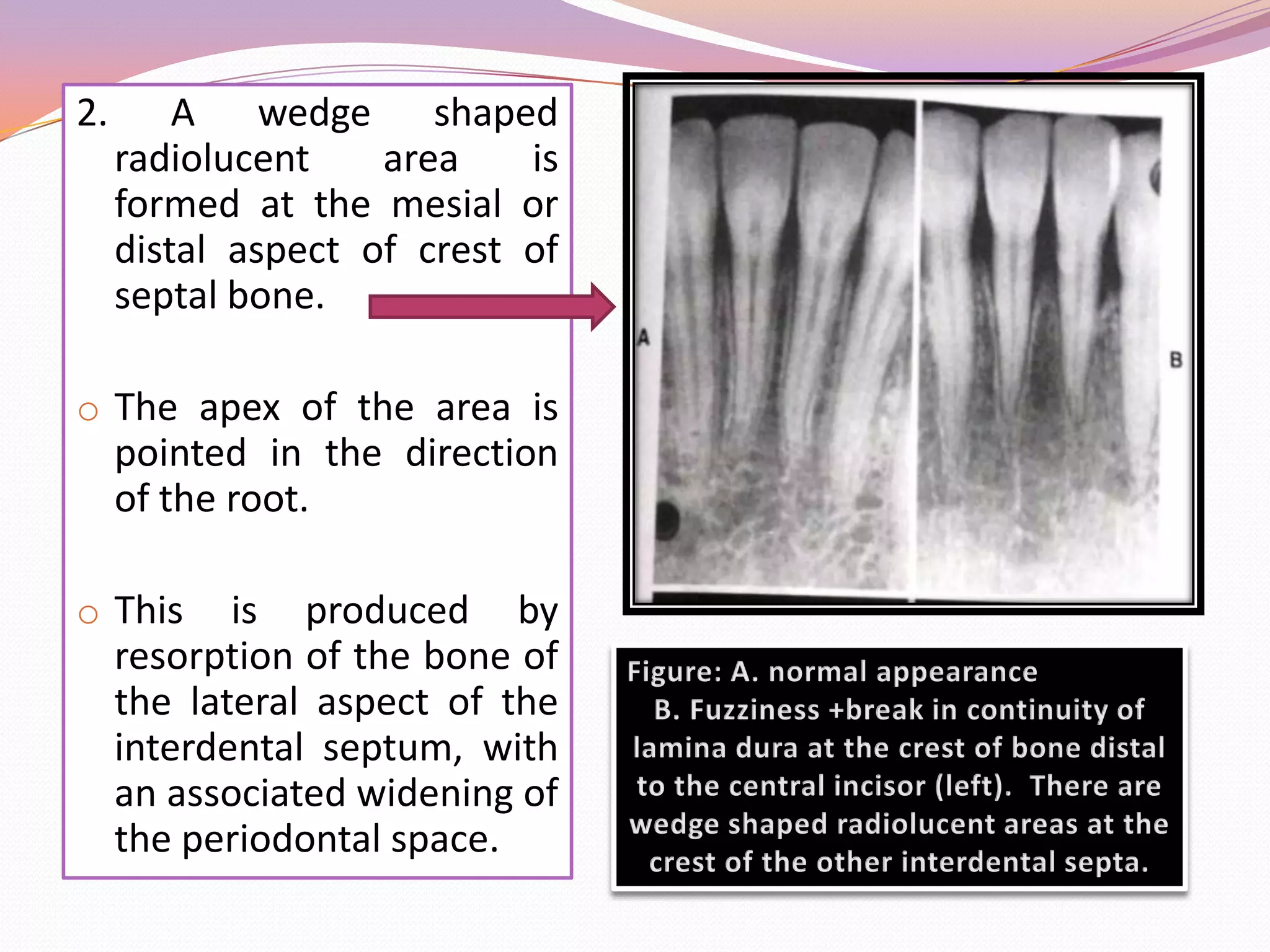 RADIOGRAPHIC AIDS IN THE DIAGNOSIS OF PERIODONTAL DISEASE | PPTX
