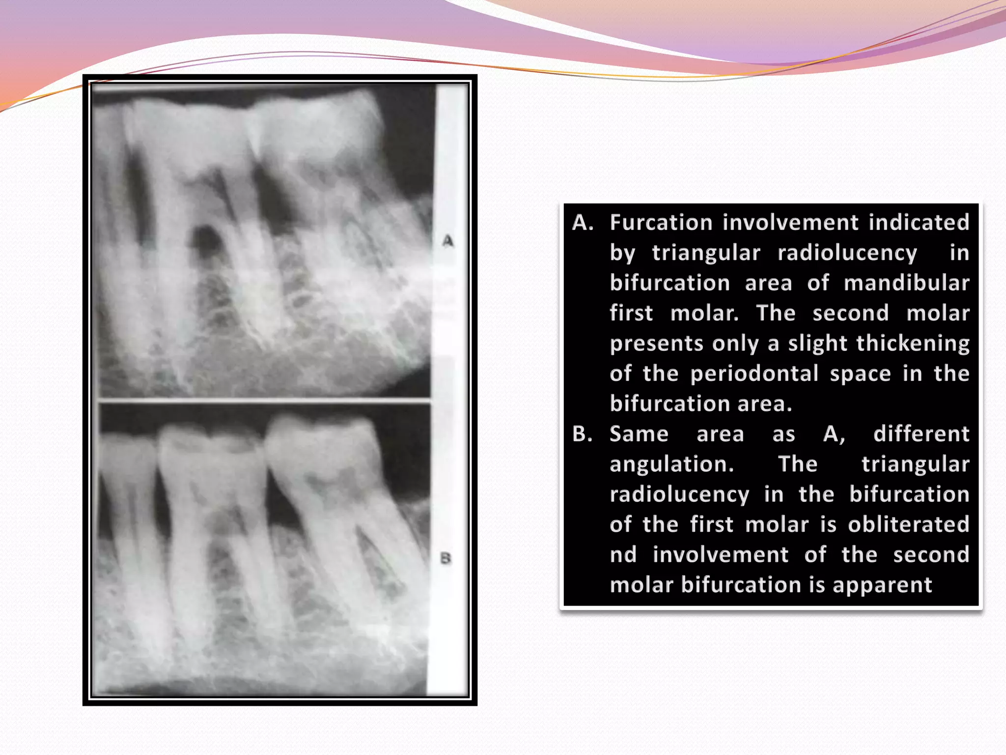 RADIOGRAPHIC AIDS IN THE DIAGNOSIS OF PERIODONTAL DISEASE | PPTX