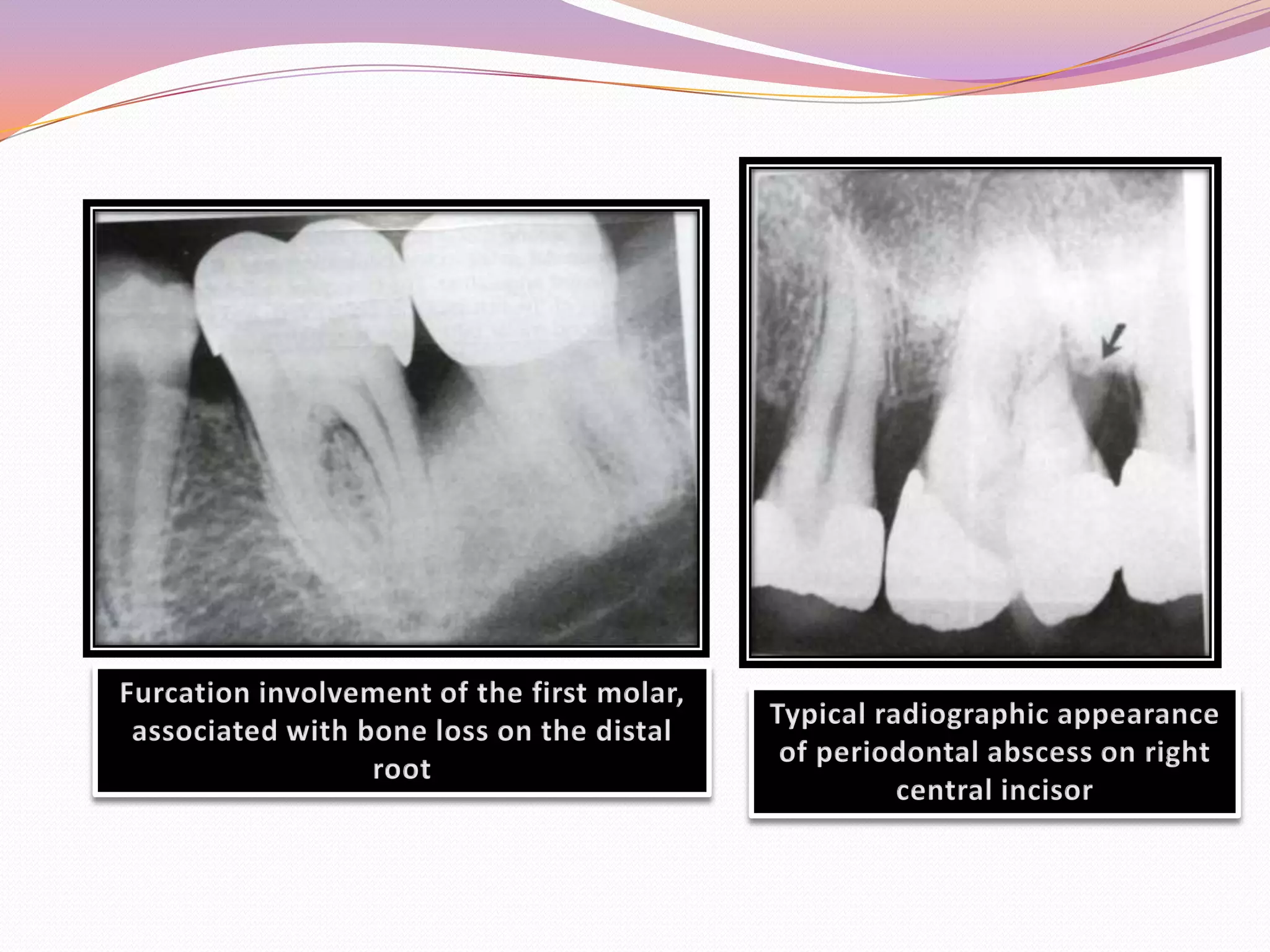 RADIOGRAPHIC AIDS IN THE DIAGNOSIS OF PERIODONTAL DISEASE | PPTX