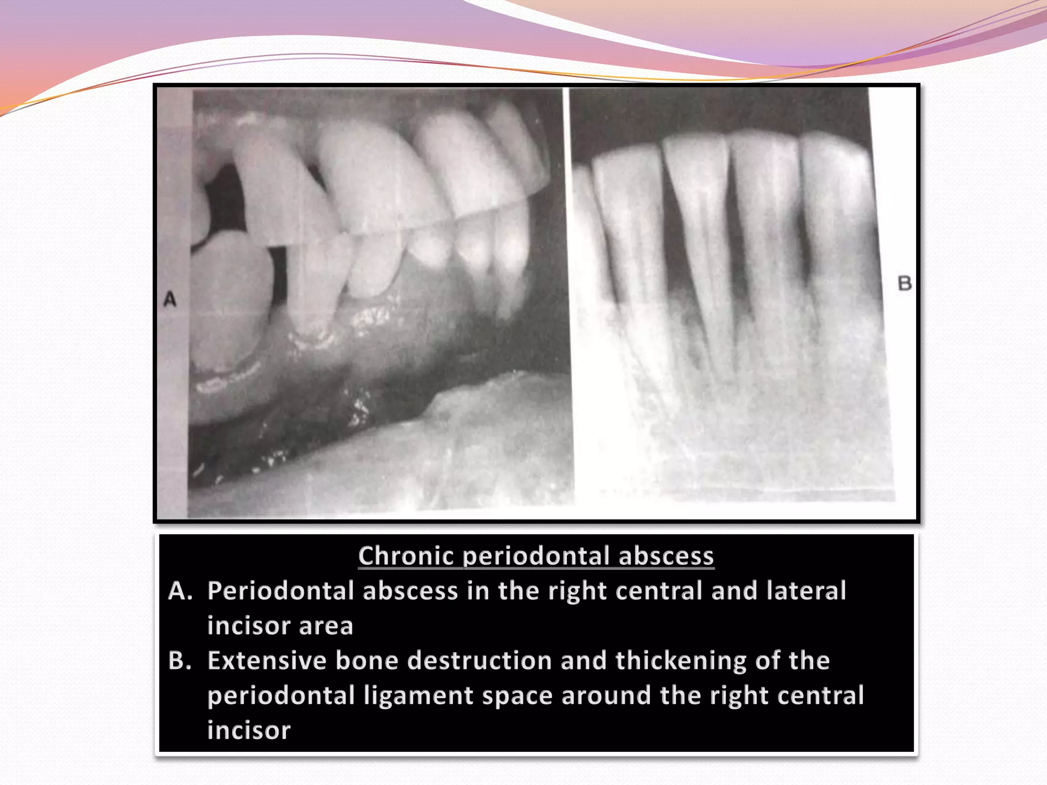 RADIOGRAPHIC AIDS IN THE DIAGNOSIS OF PERIODONTAL DISEASE | PPTX