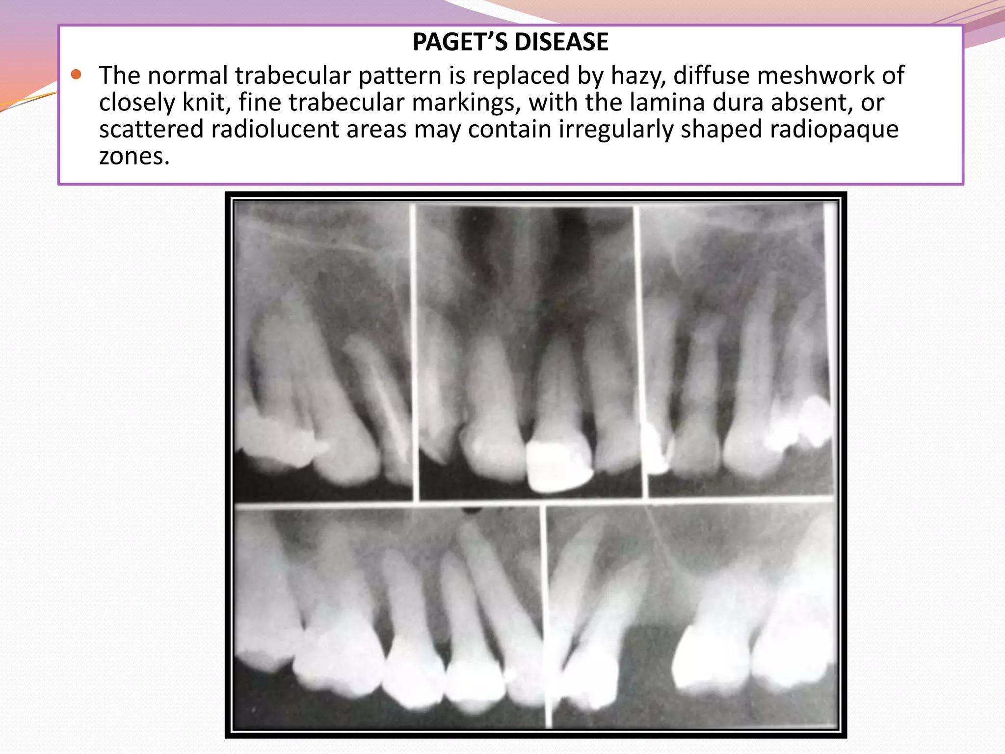 RADIOGRAPHIC AIDS IN THE DIAGNOSIS OF PERIODONTAL DISEASE | PPTX