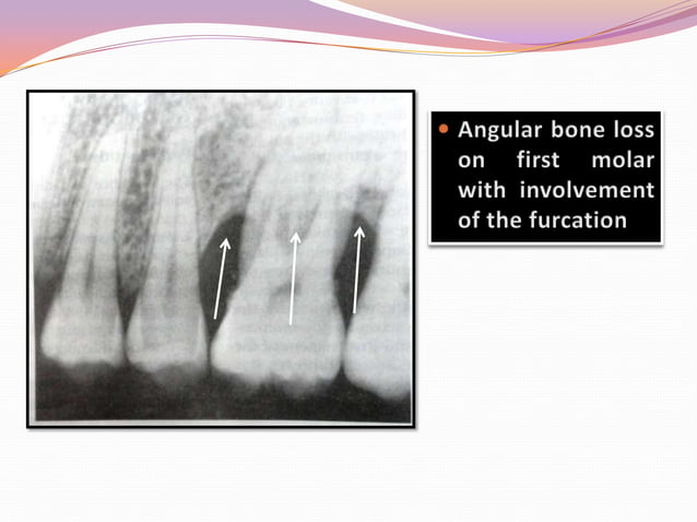 RADIOGRAPHIC AIDS IN THE DIAGNOSIS OF PERIODONTAL DISEASE | PPTX ...