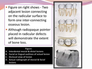 RADIOGRAPHIC AIDS IN THE DIAGNOSIS OF PERIODONTAL DISEASE | PPTX