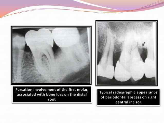 RADIOGRAPHIC AIDS IN THE DIAGNOSIS OF PERIODONTAL DISEASE | PPTX ...