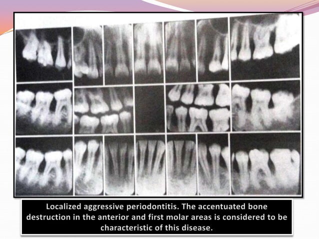 RADIOGRAPHIC AIDS IN THE DIAGNOSIS OF PERIODONTAL DISEASE | PPTX ...