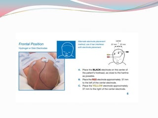 neonatal cerebral function monitoring | PPTX