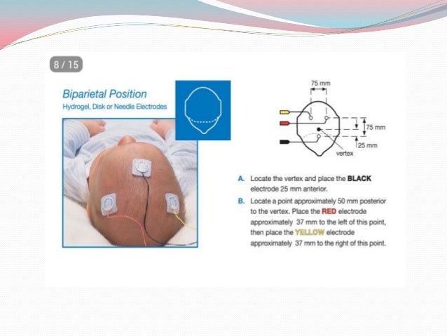 neonatal cerebral function monitoring
