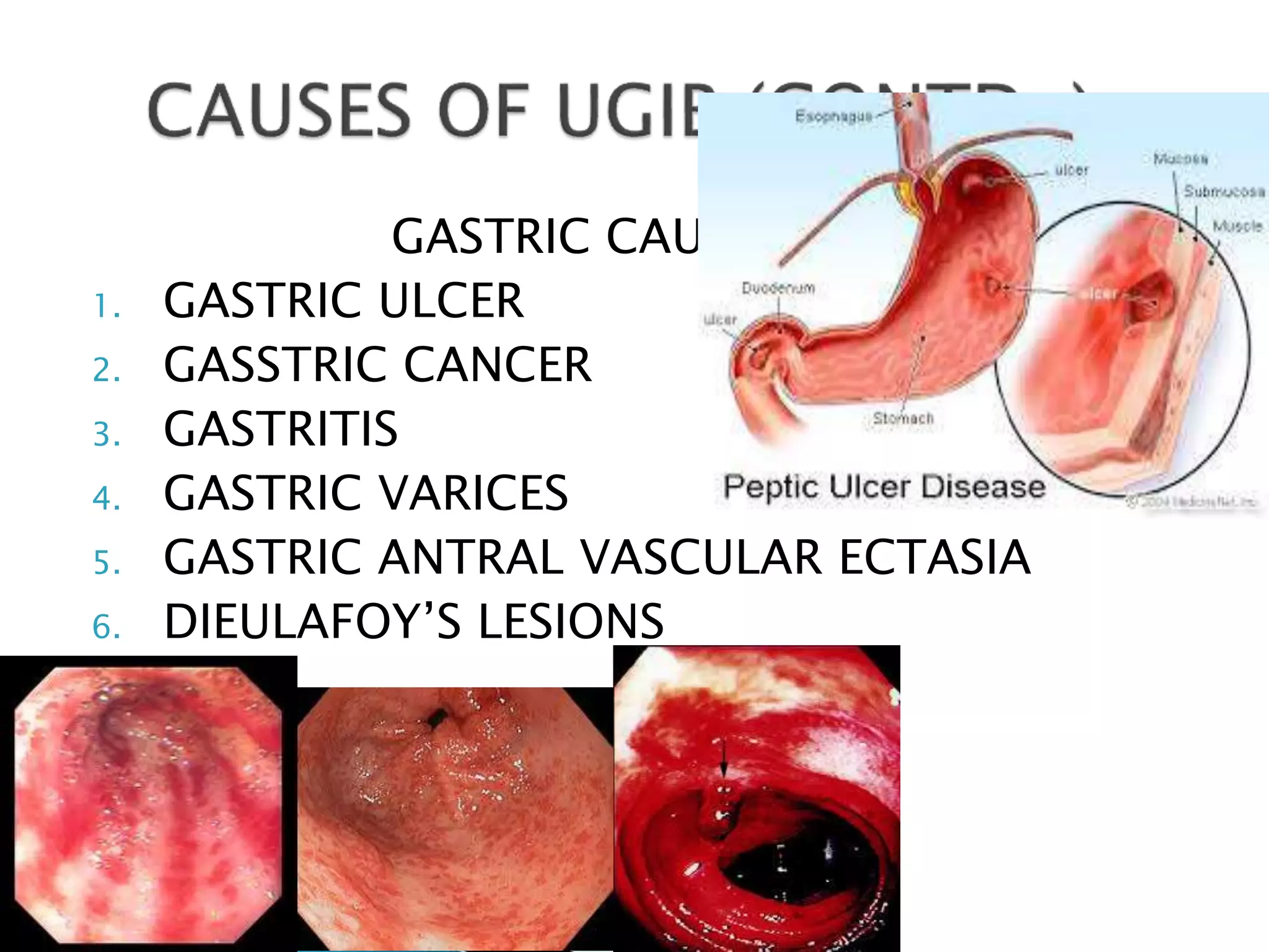 gastrointestinal bleeding | PPTX