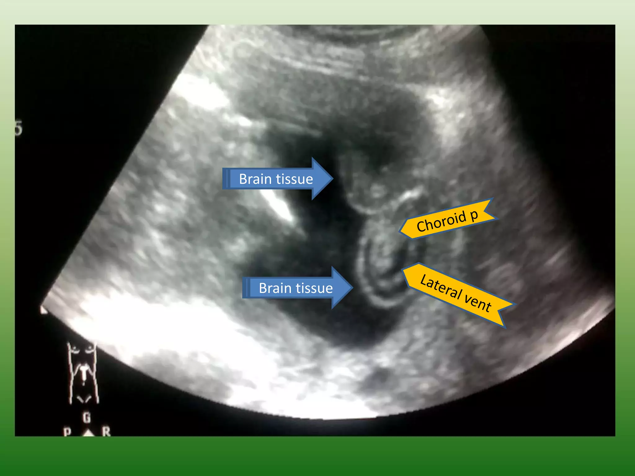 exencephaly..case