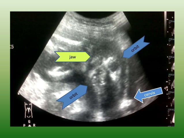 exencephaly..case