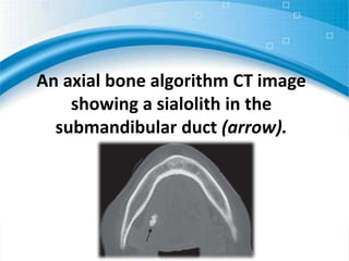 SALIVARY GLAND RADIOLOGY | PPTX