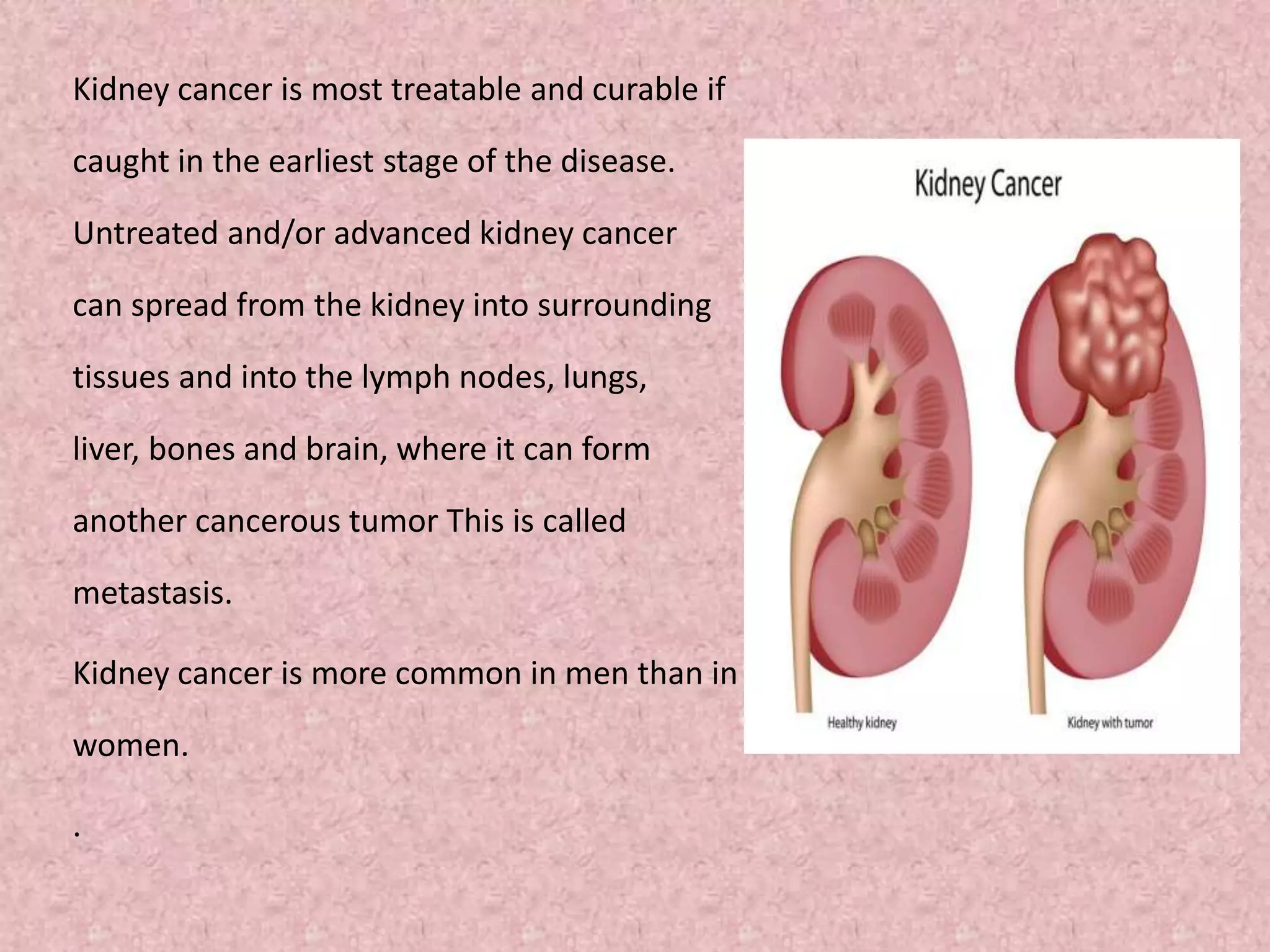 Kidney Cancer (renal cancer) | PPTX