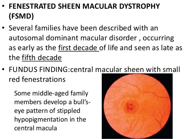 MACULAR DYSTROPHIES