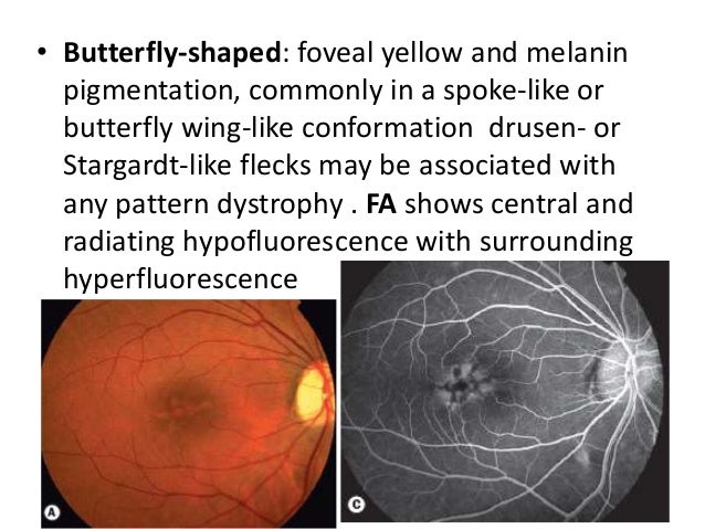 MACULAR DYSTROPHIES