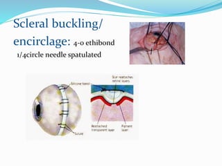 sutures and needles in ophthalmology | PPTX