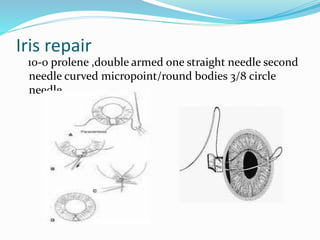 sutures and needles in ophthalmology | PPTX
