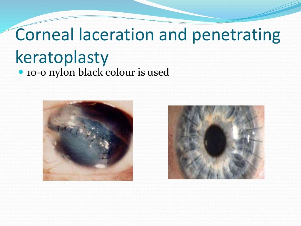 sutures and needles in ophthalmology