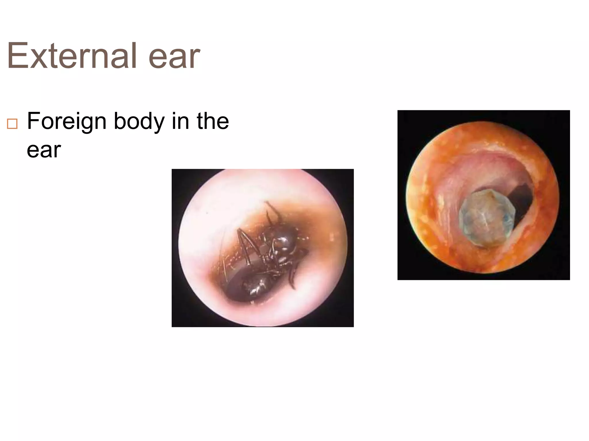 otalgia causes and management | PPTX