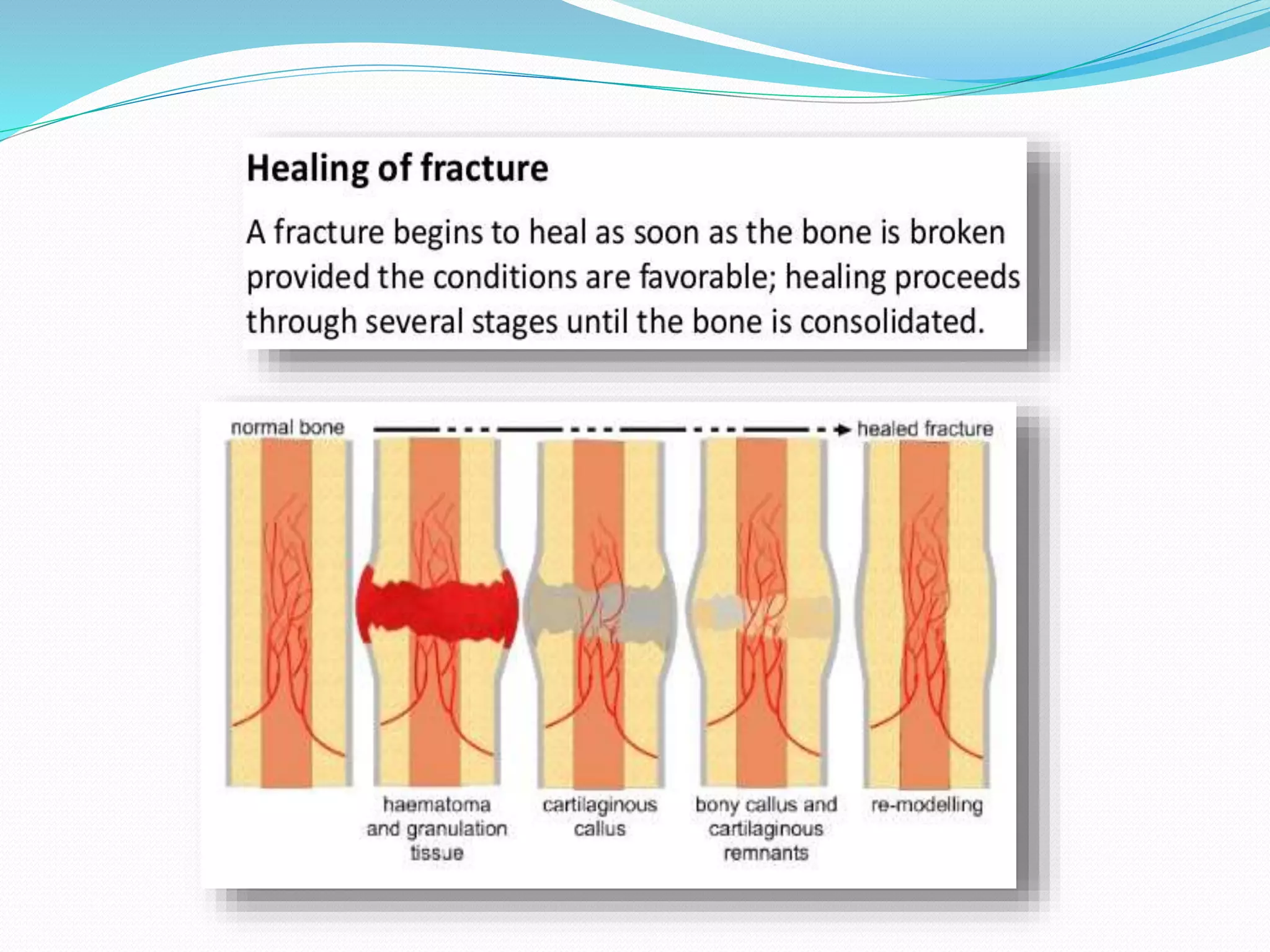 Principle of fracture management | PPT