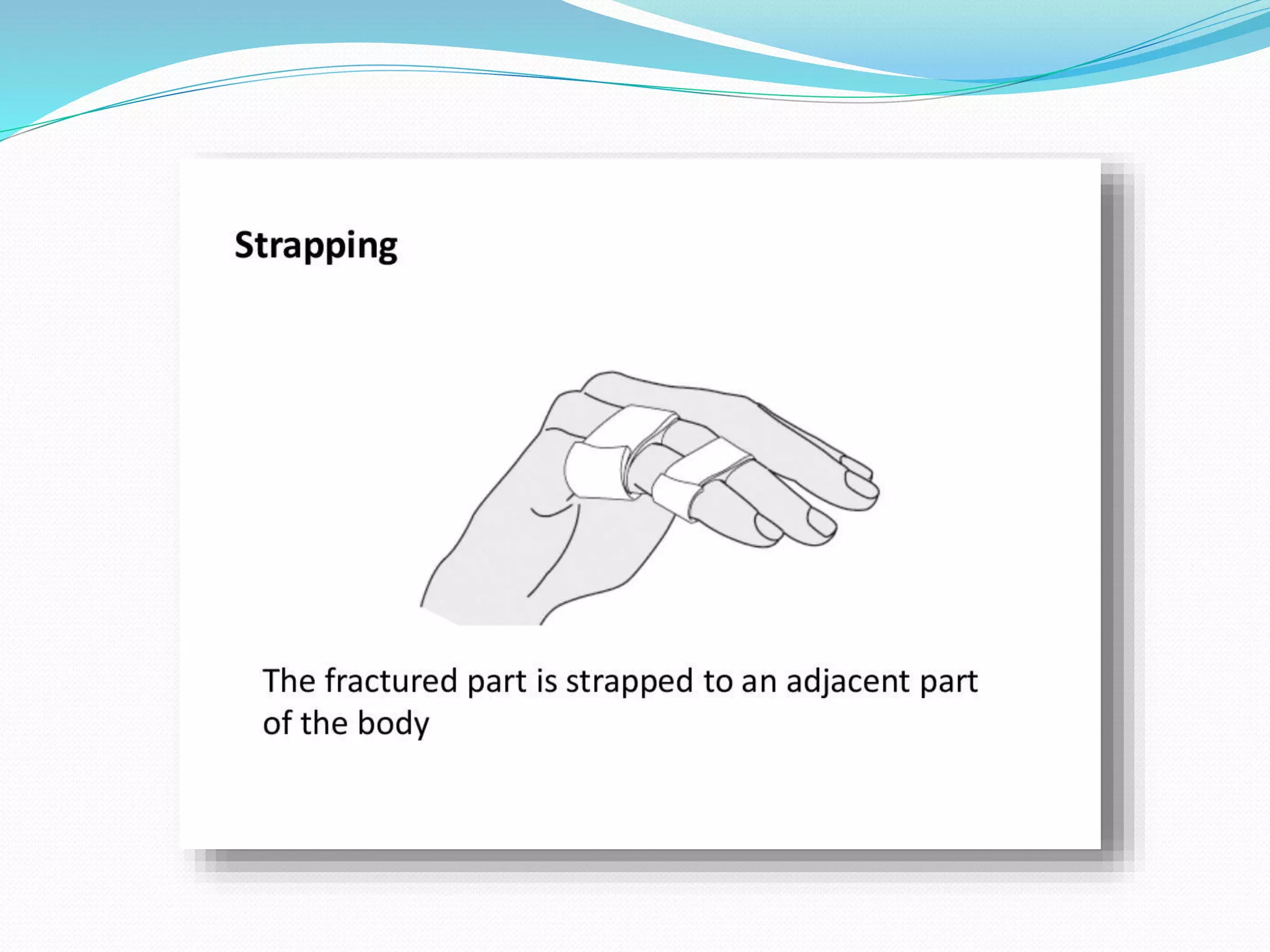 Principle of fracture management | PPTX