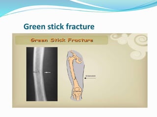 Principle of fracture management | PPTX