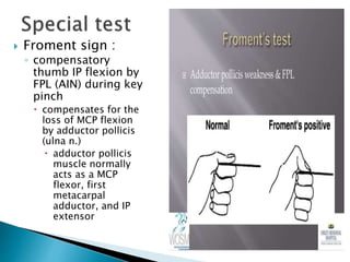 Cubital Tunnel Syndrome | PPTX