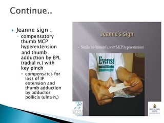 Cubital Tunnel Syndrome | PPTX