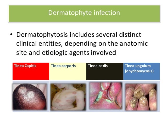 Principles of Fungal Diagnosis and Treatment