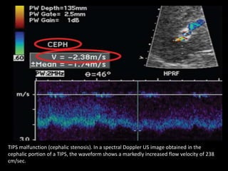 Role of Doppler in Liver Cirrhosis & Portal Hypertension | PPTX