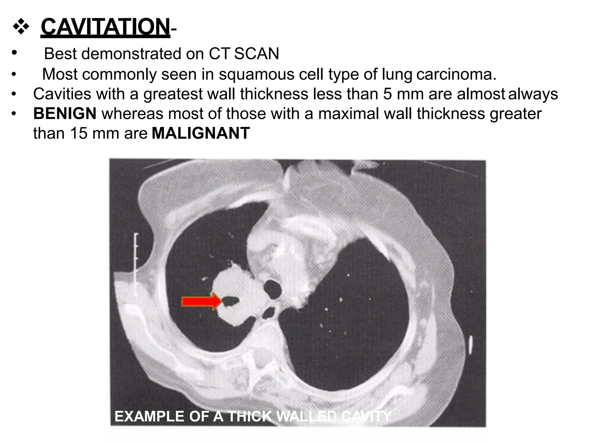 BENIGN AND MALIGNANT LUNG NEOPLASAM MASSES | PPTX